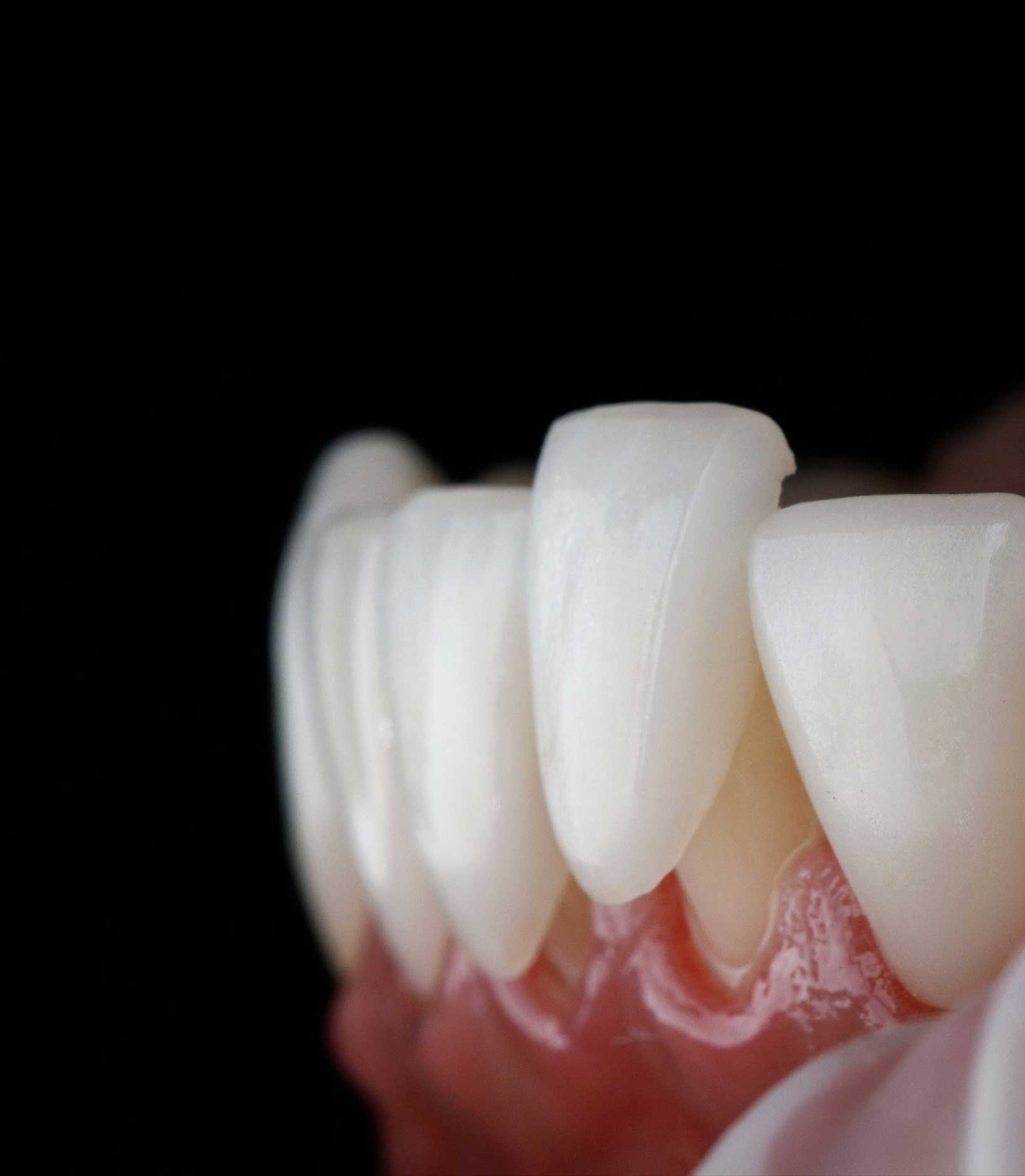 #1 Dental Veneers in Florida | Transform Your Smile with Nuvo Dental in ...