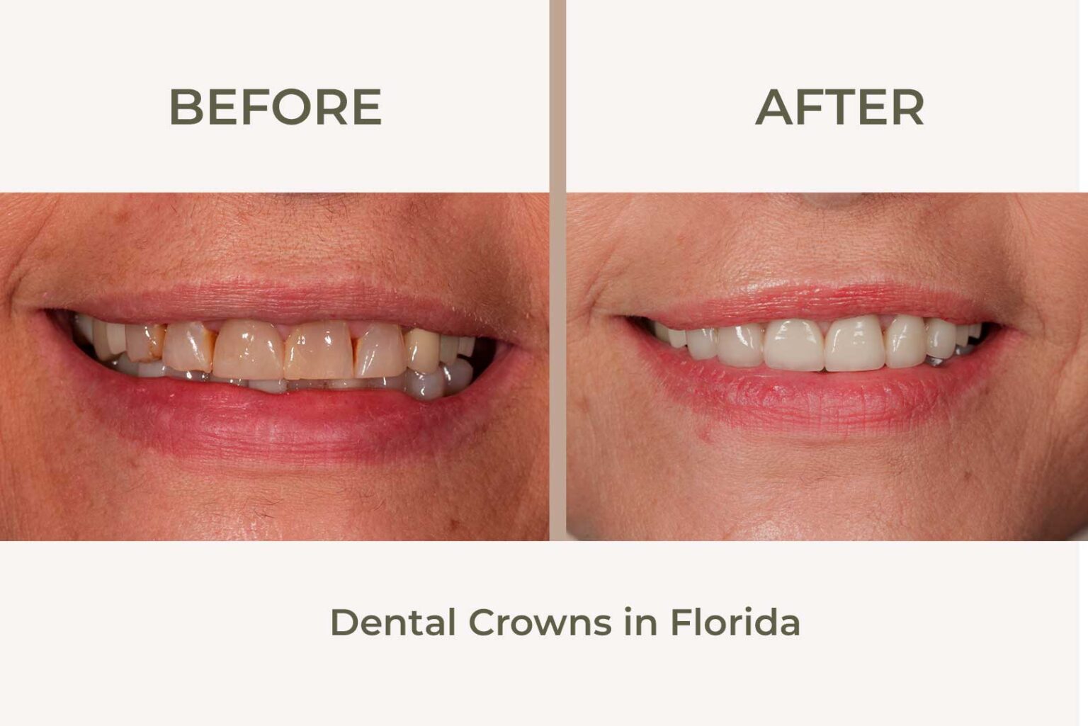 Dental Crowns in Florida: Restoring Your Smile with Strength and Beauty ...