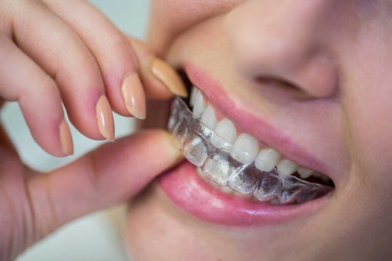 Invisalign en Orlando 2025 | Ortodoncia Invisible para Adultos con el ...